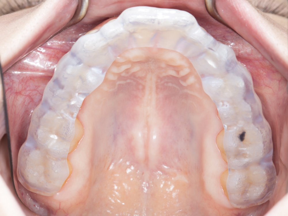 Occlusal Splint Product Spotlight: Comfort3D Bite Splint
