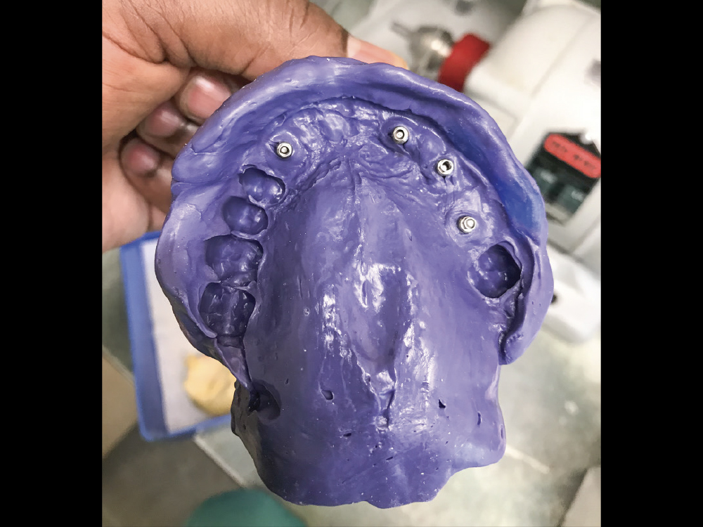 Partial Edentulism: Restoring Form and Function