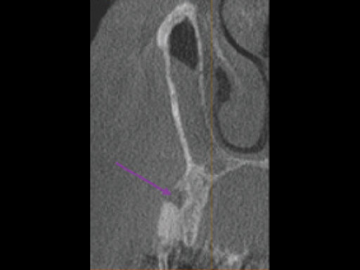 7 Steps for Treating Fenestrations Within Implant Sites