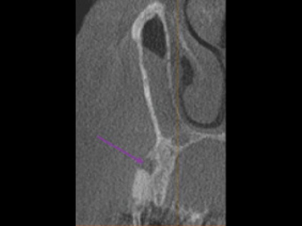 7 Steps for Treating Fenestrations Within Implant Sites