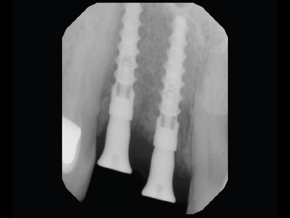 7 Steps for Treating Fenestrations Within Implant Sites