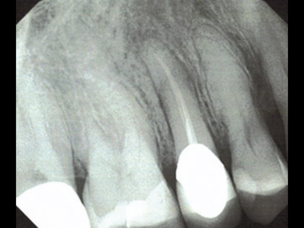 7 Steps for Treating Fenestrations Within Implant Sites