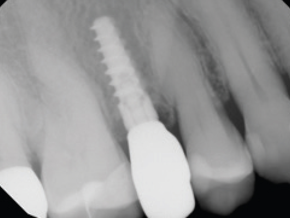 7 Steps for Treating Fenestrations Within Implant Sites