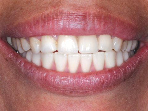 Complete Dentures: Troubleshooting Common Complaints