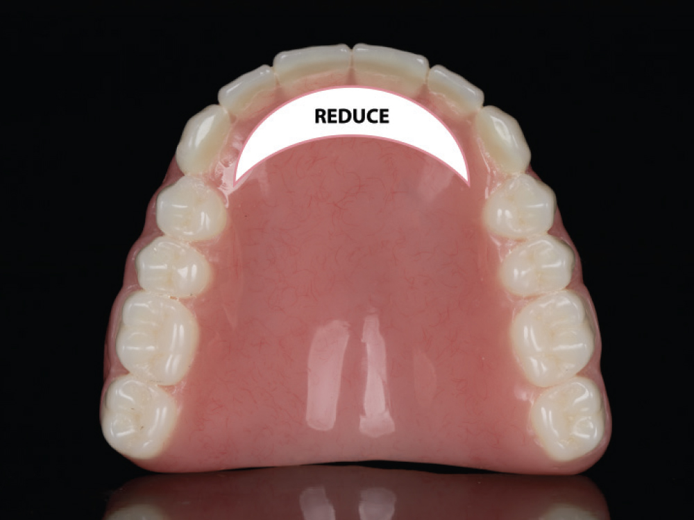 Complete Dentures: Troubleshooting Common Complaints