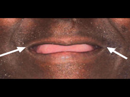 Complete Dentures: Troubleshooting Common Complaints