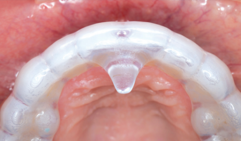 Product Spotlight: BruxZir® Shade Guides | NTI OmniSplint®