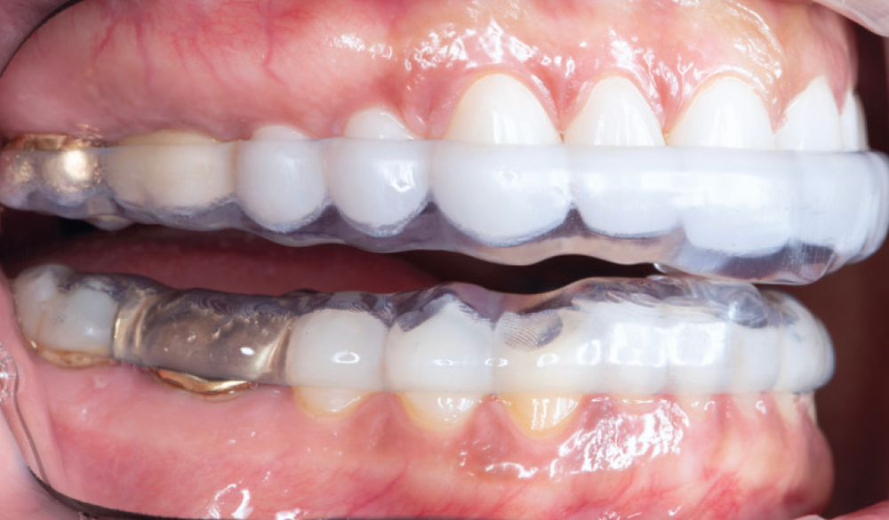 Product Spotlight: BruxZir® Shade Guides | NTI OmniSplint®