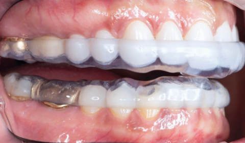 Product Spotlight: BruxZir® Shade Guides | NTI OmniSplint®