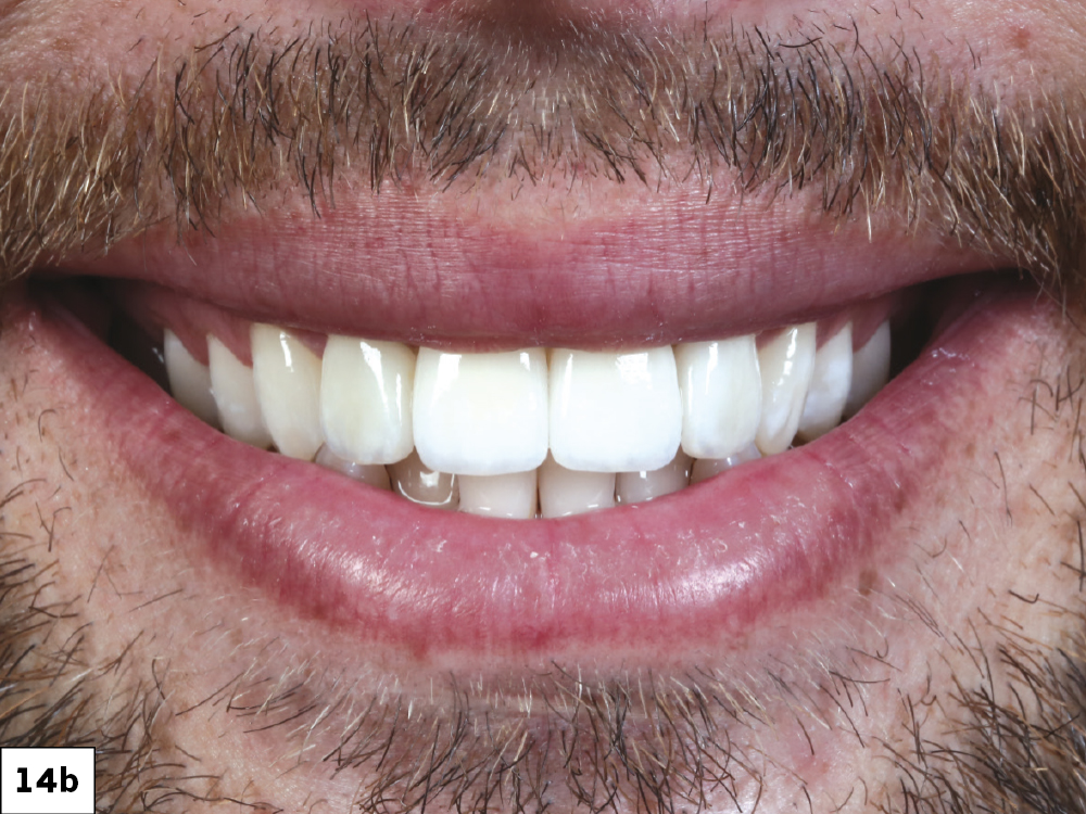 Benefits of a Diagnostic Wax-Up to Preview a Smile Makeover