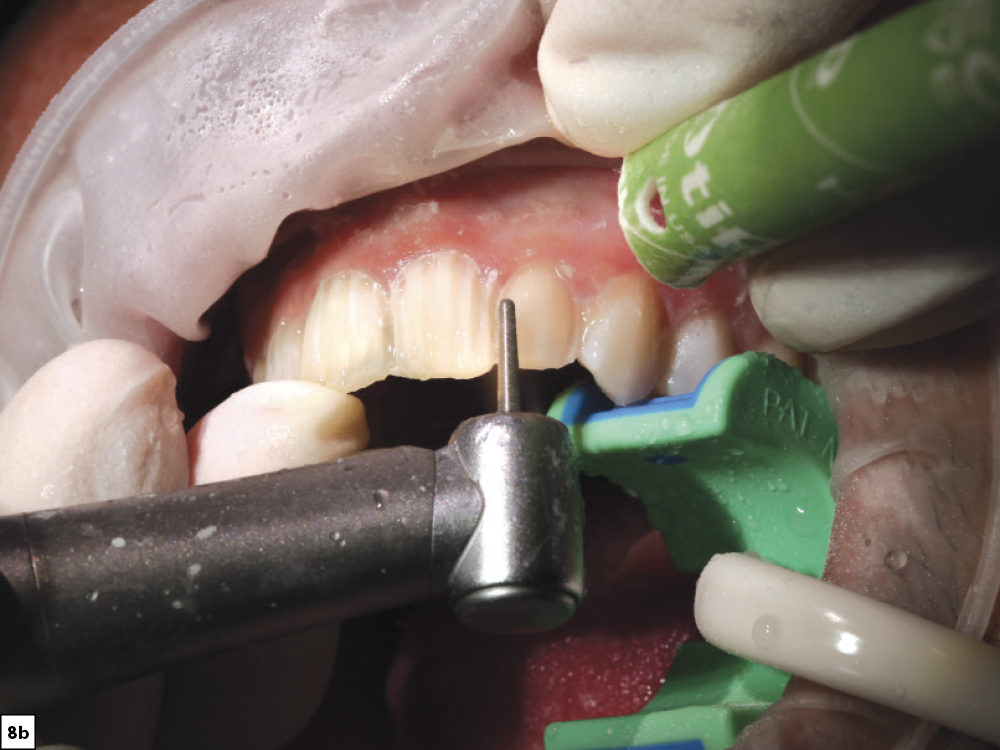 Benefits of a Diagnostic Wax-Up to Preview a Smile Makeover
