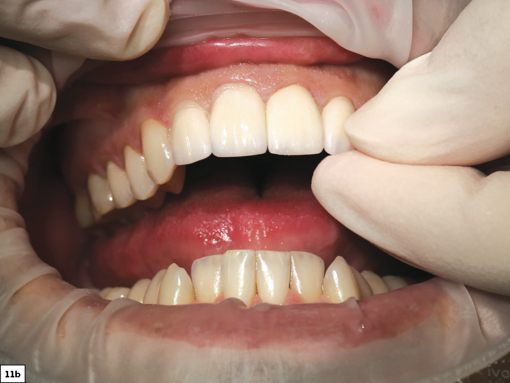 Benefits of a Diagnostic Wax-Up to Preview a Smile Makeover