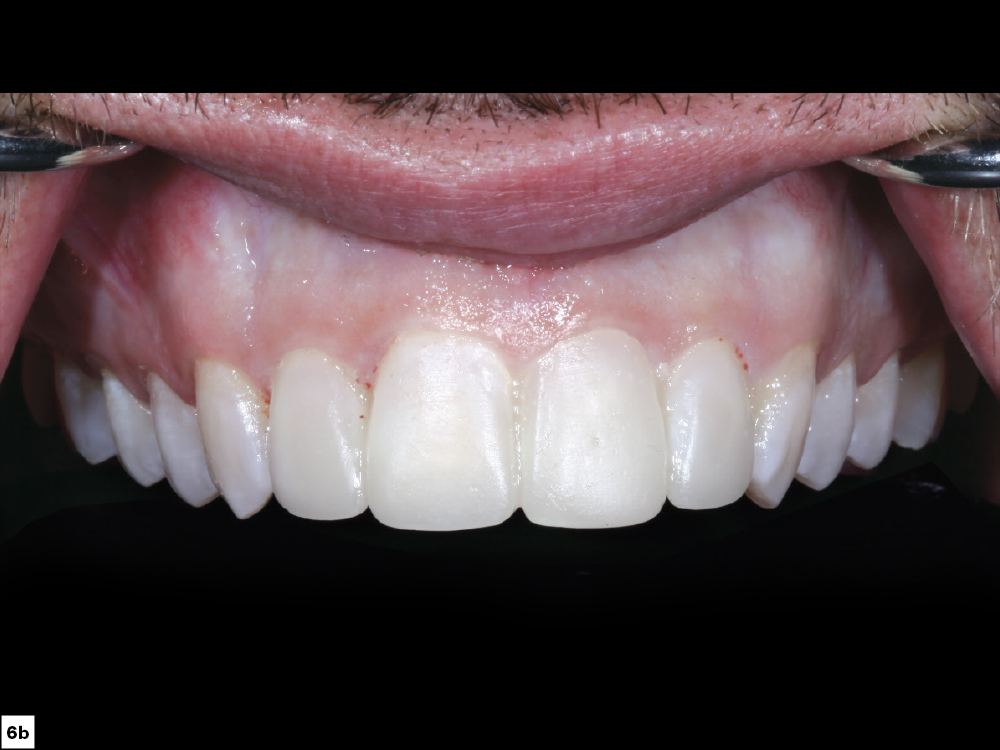 Benefits of a Diagnostic Wax-Up to Preview a Smile Makeover