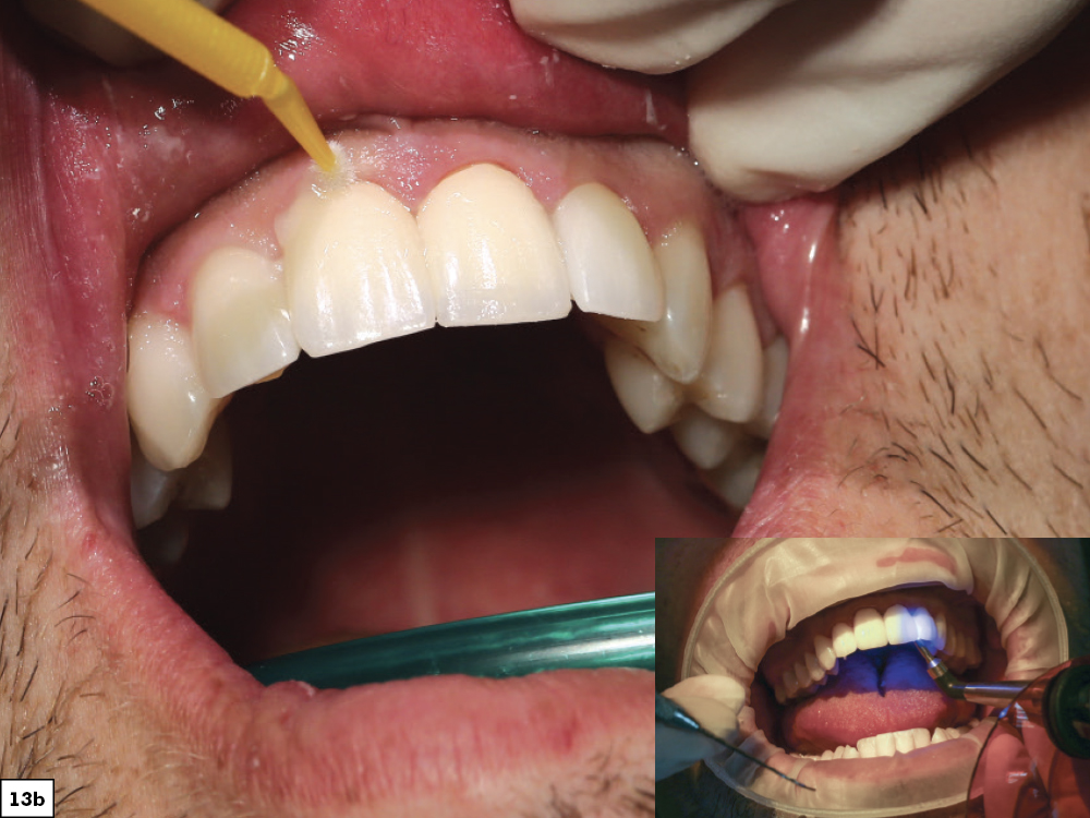 Benefits of a Diagnostic Wax-Up to Preview a Smile Makeover