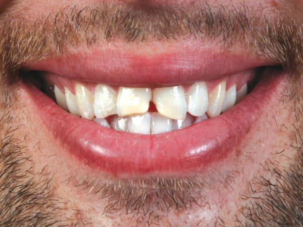Benefits of a Diagnostic Wax-Up to Preview a Smile Makeover
