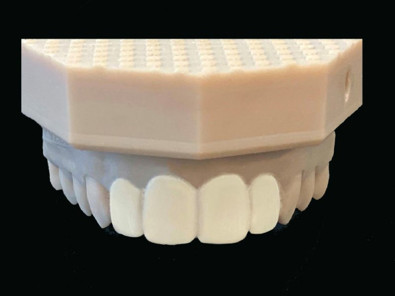 Benefits of a Diagnostic Wax-Up to Preview a Smile Makeover