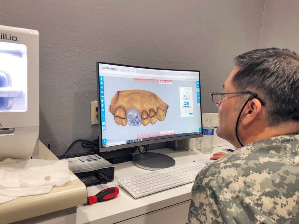 The Benefits of Chairside CAD/CAM Dental For Your Patients