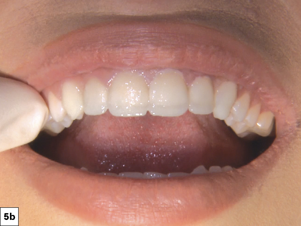 Esthetic Dentistry: A 'Redo' Case