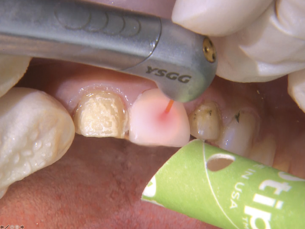 Esthetic Dentistry: A 'Redo' Case