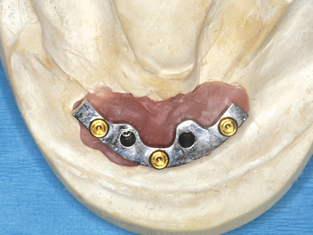 Implant Bar Overdentures | Case Report