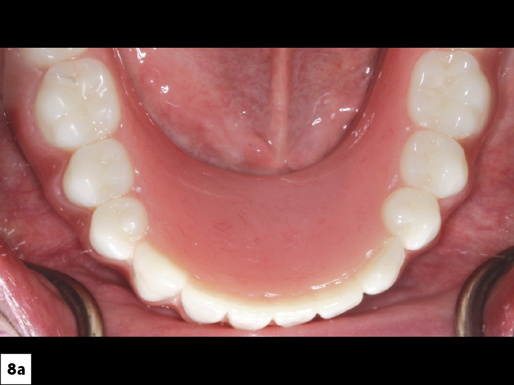 Implant Bar Overdentures | Case Report
