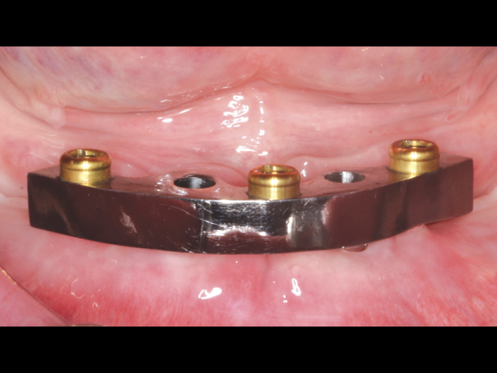 Implant Bar Overdentures | Case Report