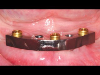 Implant Bar Overdentures | Case Report