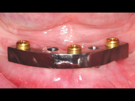 Implant Bar Overdentures | Case Report