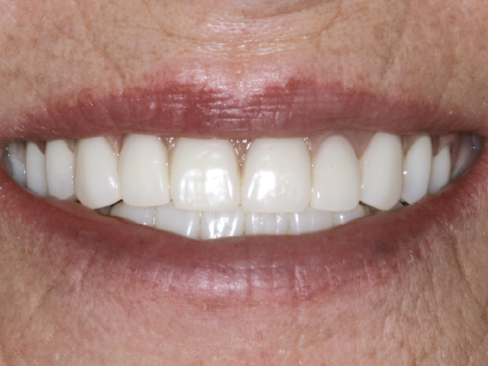 Implant Bar Overdentures | Case Report