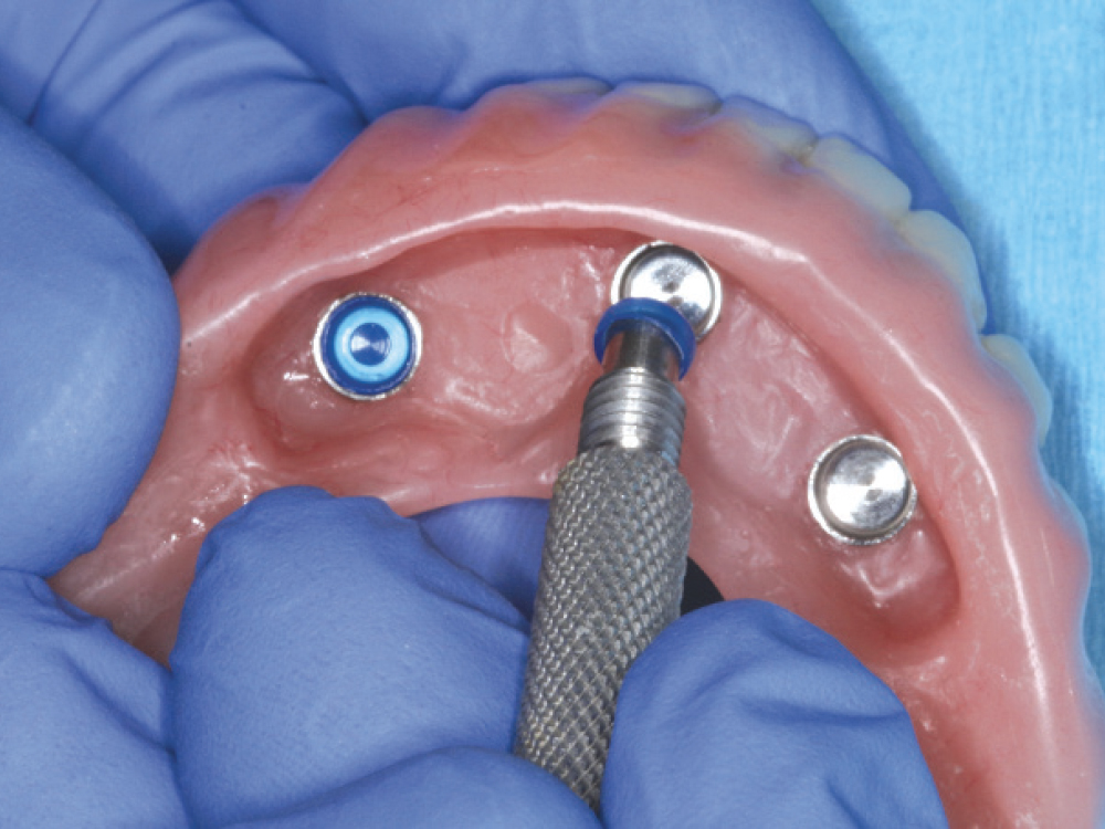 Implant Bar Overdentures | Case Report