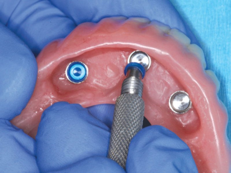Implant Bar Overdentures | Case Report