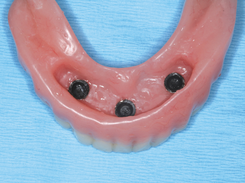 Implant Bar Overdentures | Case Report