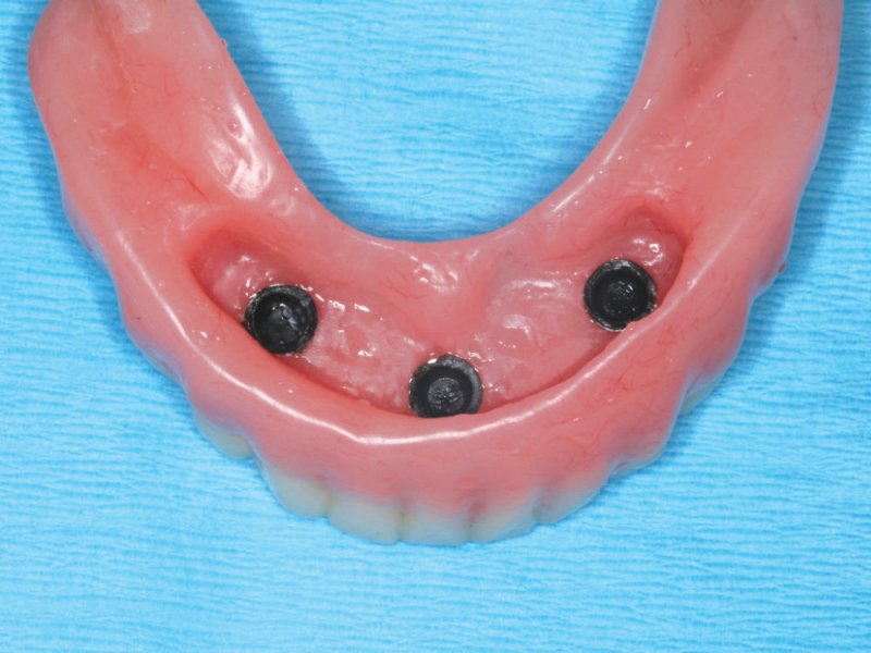 Implant Bar Overdentures | Case Report