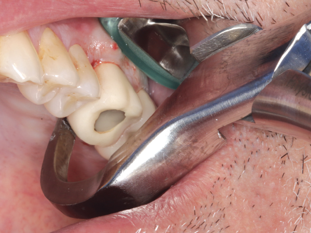 Maxillary First Molar: Extract, Socket Grafting & Sinus Lift