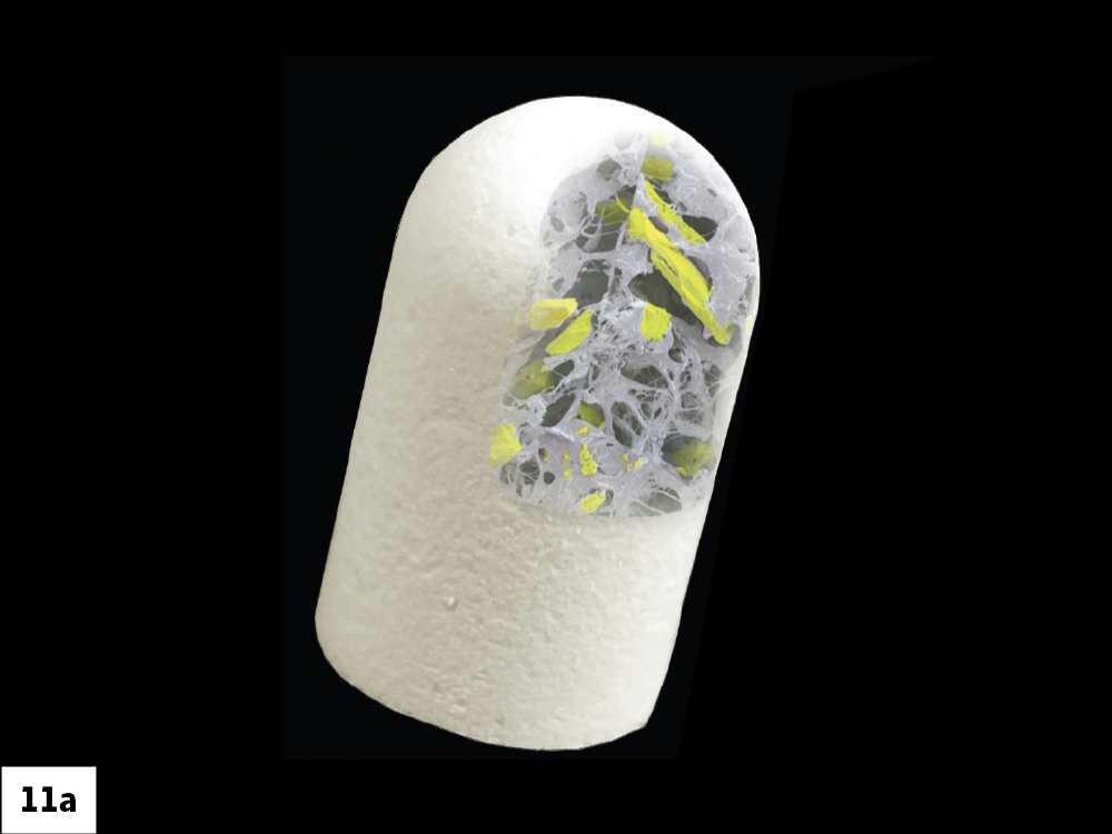 Maxillary First Molar: Extract, Socket Grafting & Sinus Lift