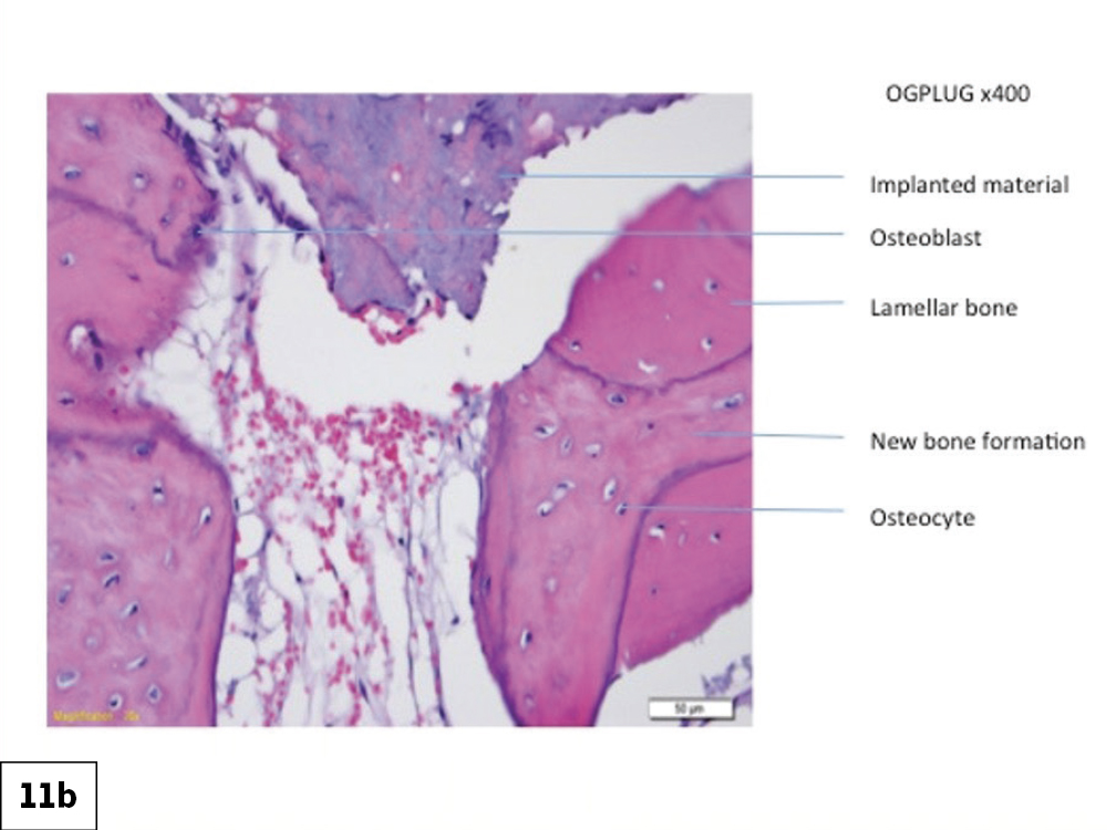 Maxillary First Molar: Extract, Socket Grafting & Sinus Lift