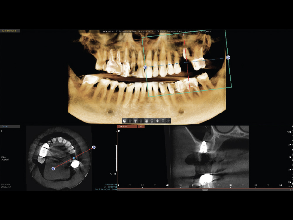 Maxillary First Molar: Extract, Socket Grafting & Sinus Lift