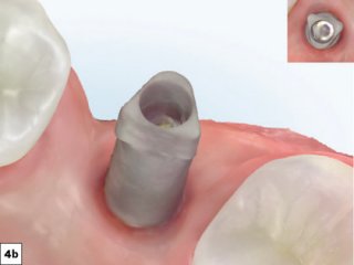 4 Steps to Capture Accurate Digital Dental Impressions