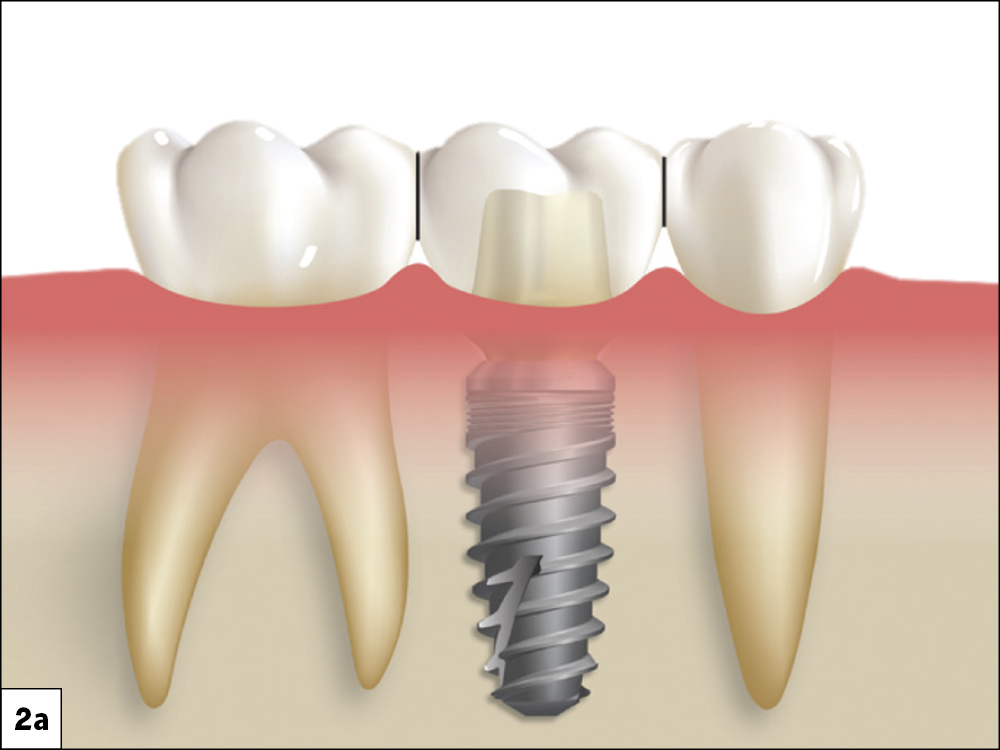 4 Steps to Capture Accurate Digital Dental Impressions