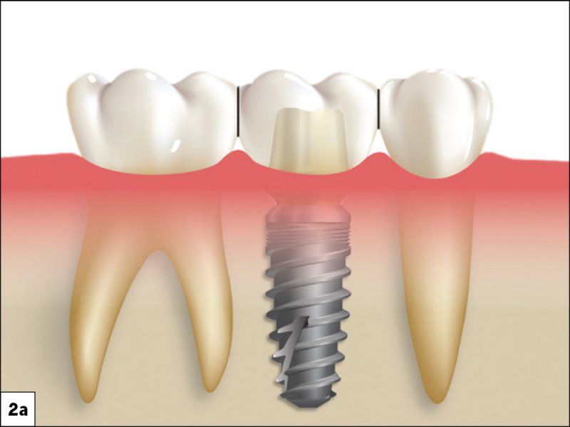 4 Steps to Capture Accurate Digital Dental Impressions