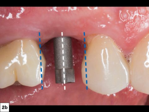 4 Steps to Capture Accurate Digital Dental Impressions