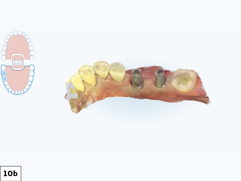 4 Steps to Capture Accurate Digital Dental Impressions