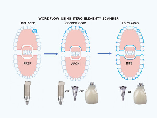 4 Steps to Capture Accurate Digital Dental Impressions