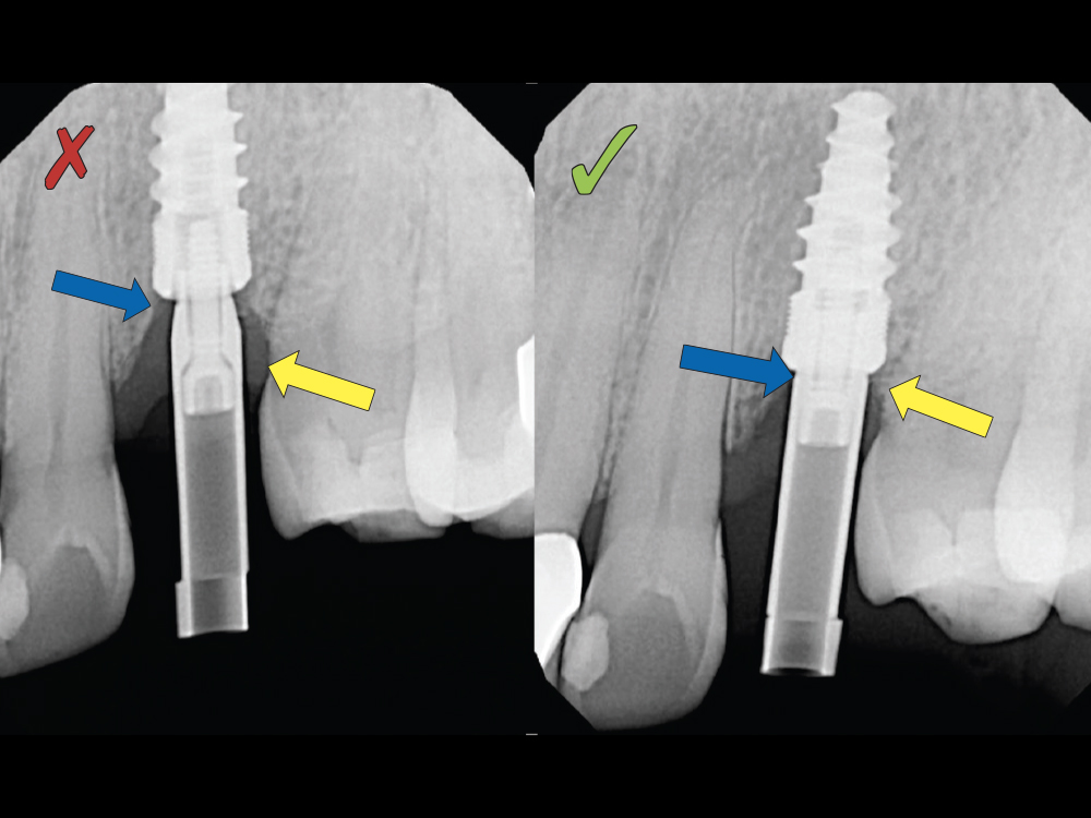 4 Steps to Capture Accurate Digital Dental Impressions