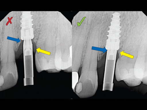 4 Steps to Capture Accurate Digital Dental Impressions