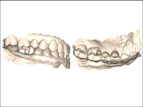 4 Steps to Capture Accurate Digital Dental Impressions