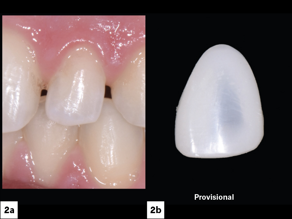 Veneer Preparation and Temporization: Tips and Techniques