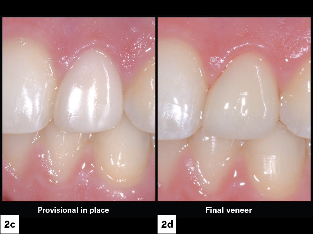 Veneer Preparation and Temporization: Tips and Techniques