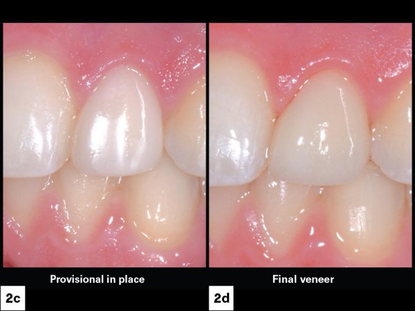 Veneer Preparation and Temporization: Tips and Techniques