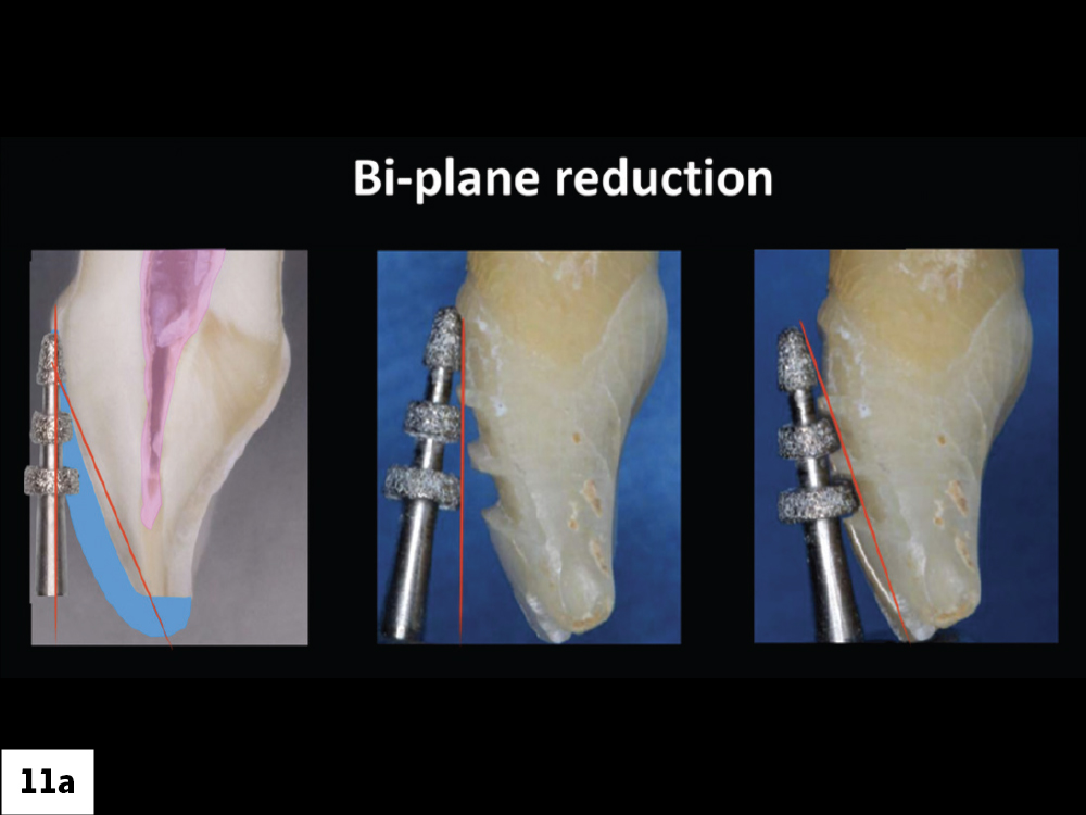 Veneer Preparation and Temporization: Tips and Techniques